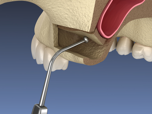 Sinus Lift in Dallas, TX | Book a Free Dental Implant Consultation